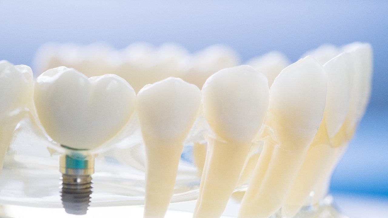 Tipos de implantes dentales - Dental Huelin